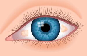 WHAT IS A PINGUECULA? » Silverstein Eye Centers : Silverstein Eye Centers